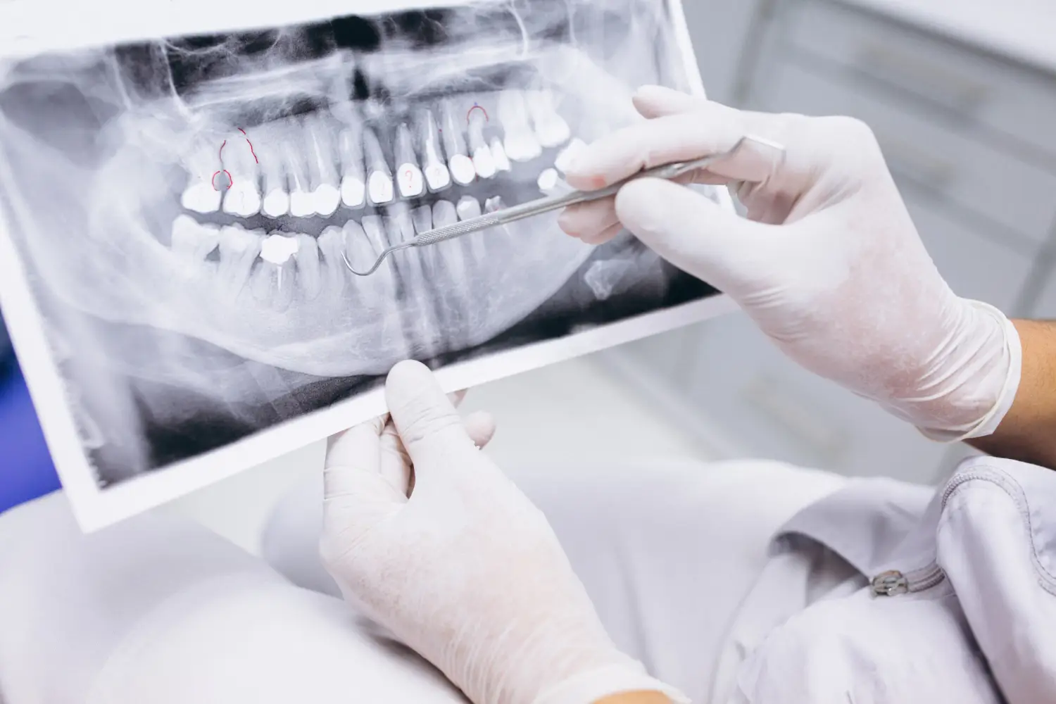 Understanding Impacted Teeth and the Modern Solutions for Treatment ...